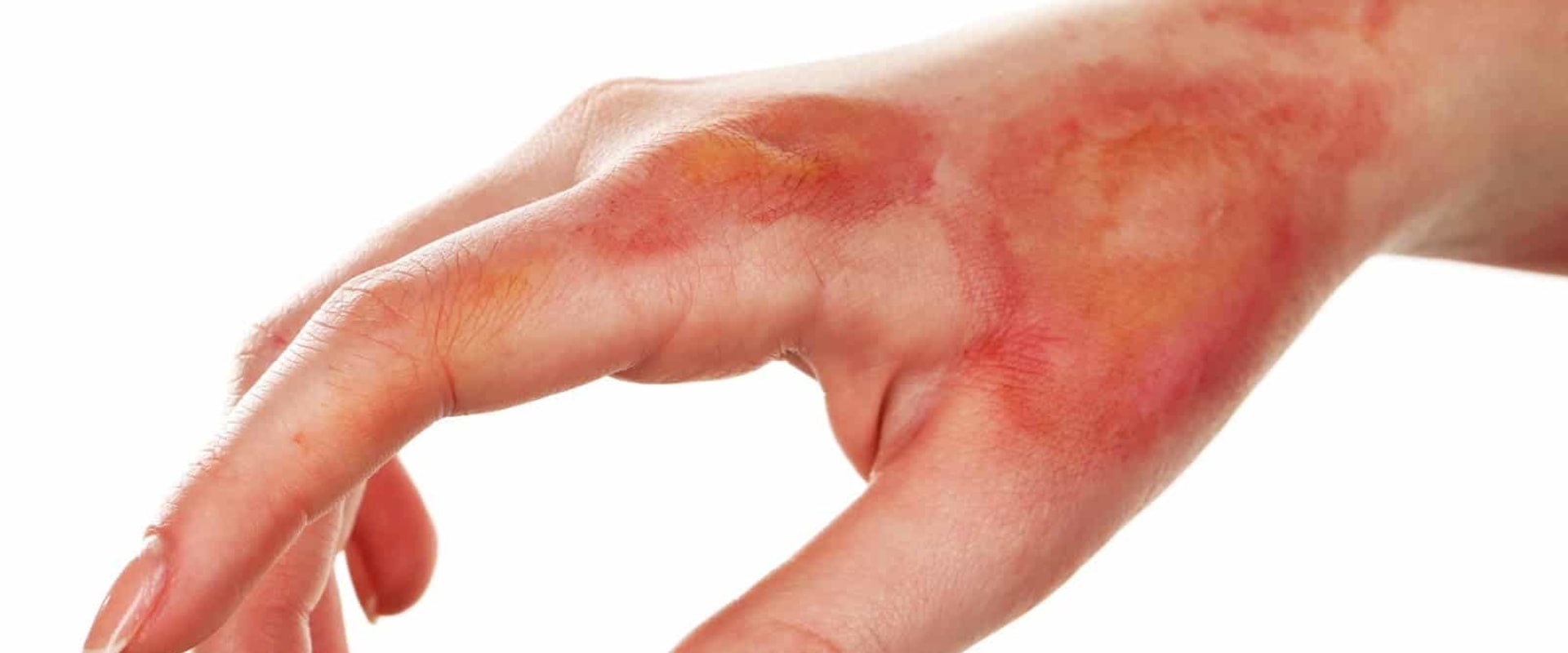 Understanding the Different Types of Burns